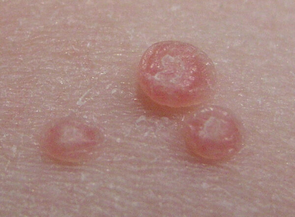 Pediatric Molluscum – Fairfield Dermatology